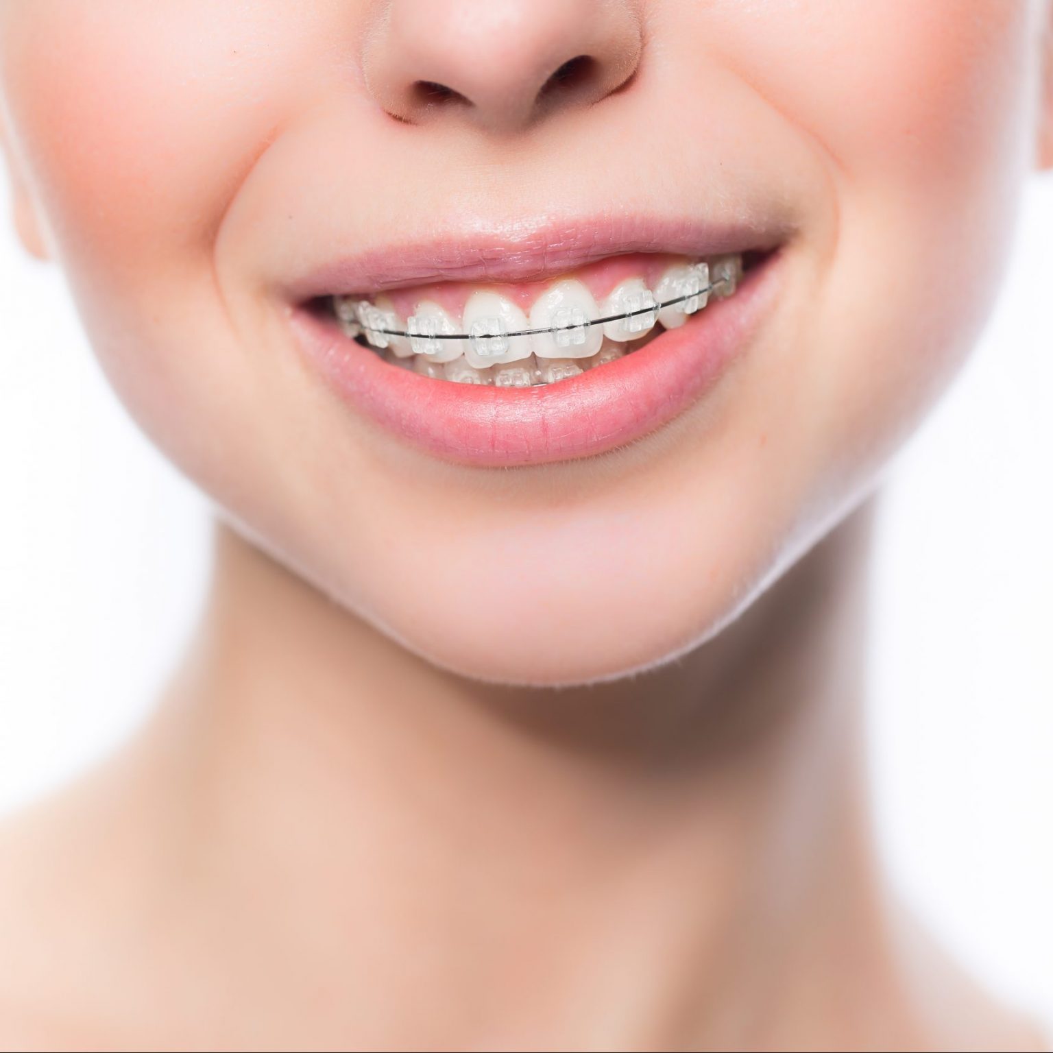 Festsitzende Zahnspange - Kieferorthopädie Dr. Krop